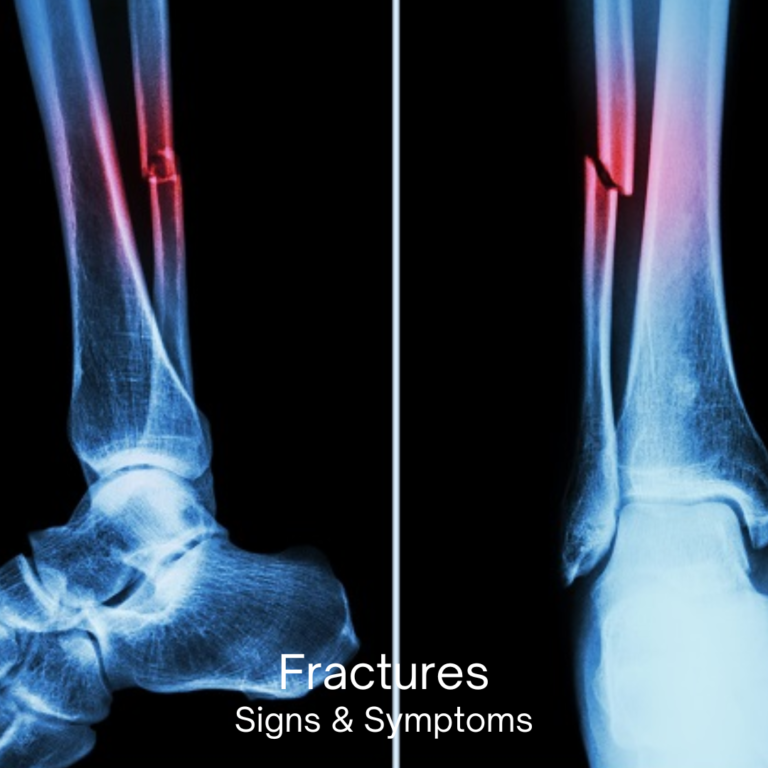 Understanding Fractures: Causes, Types, and Treatment